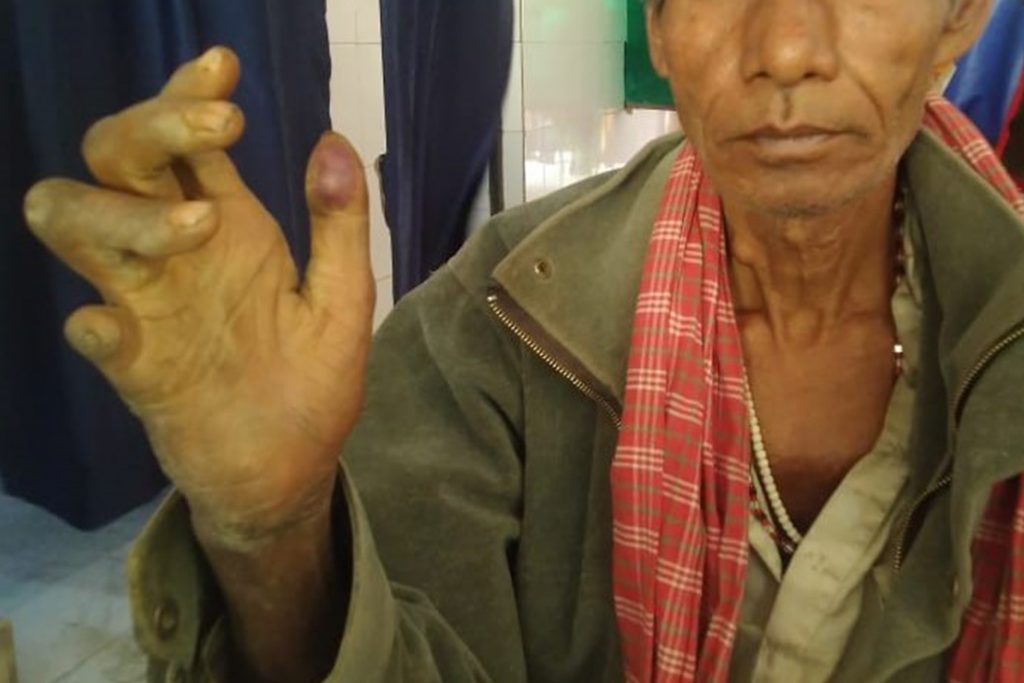 Leprosy: a devastating disease of today - Rotary in Great Britain and ...